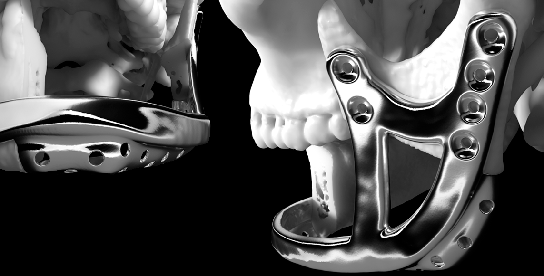 Plameca ProModel - Patient specific implants